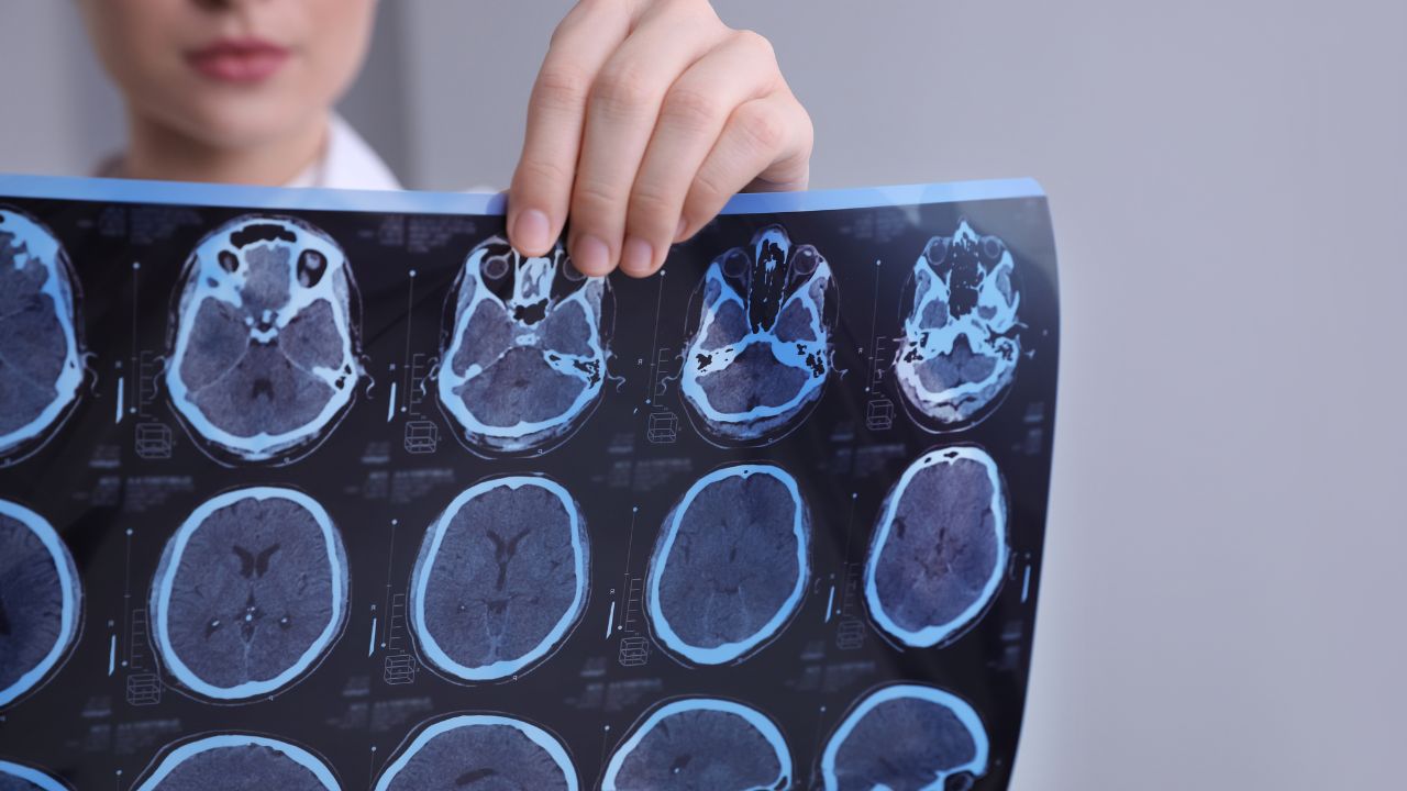 Advancements in concussion management: Insights from Dr. Steven Broglio ...